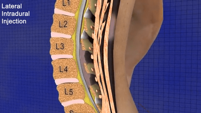 Video: Lateral - Intradural Injection | Lyons & Simmons, LLP
