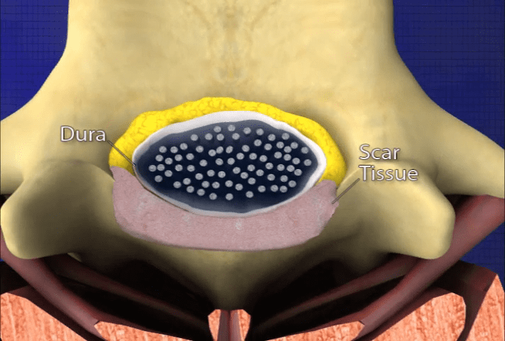 Video: Subdural Injection | Lyons & Simmons, LLP